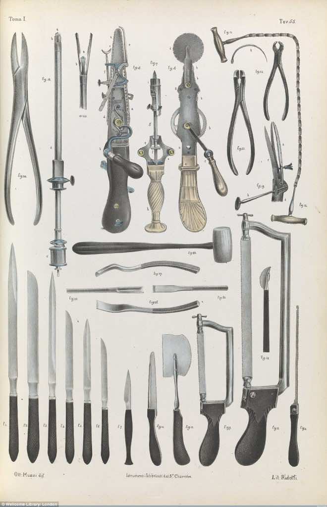This Is How Surgeries Were Done In 17th Century When Anesthe