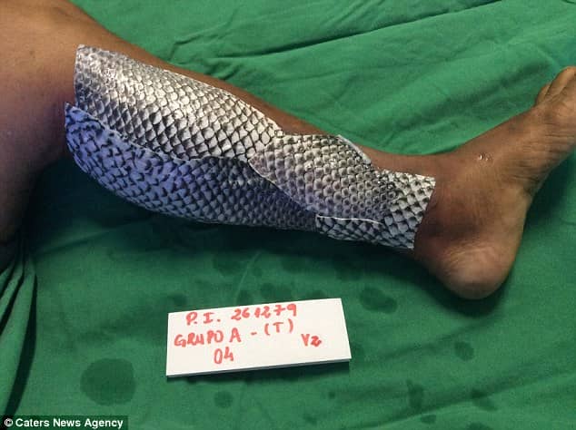 Brazil Doctors Are Using Fish Skin To Treat Burn Victims In