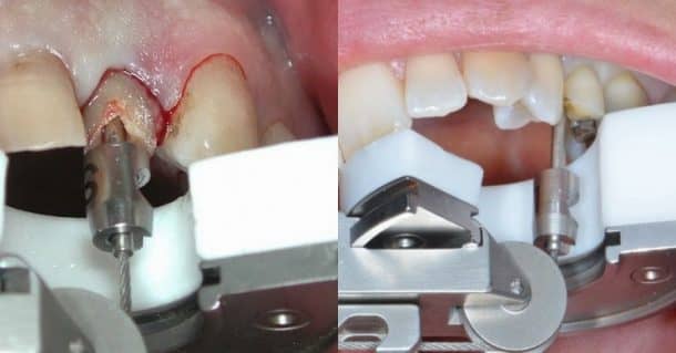 This New Dental Tool Is The Solution To All The Painful Toot