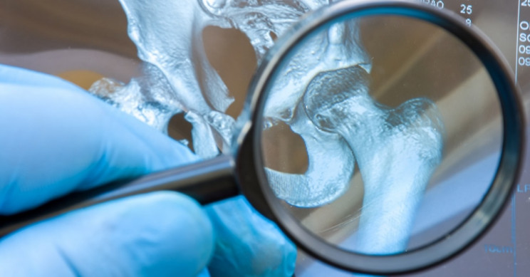 Researchers Develop Material That Mimics Human Bone Tissue