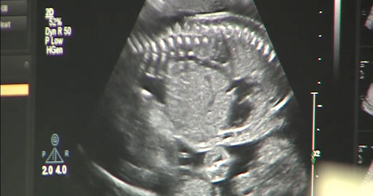 Cleveland Clinic Conducts Its First Successful Fetal Surgery
