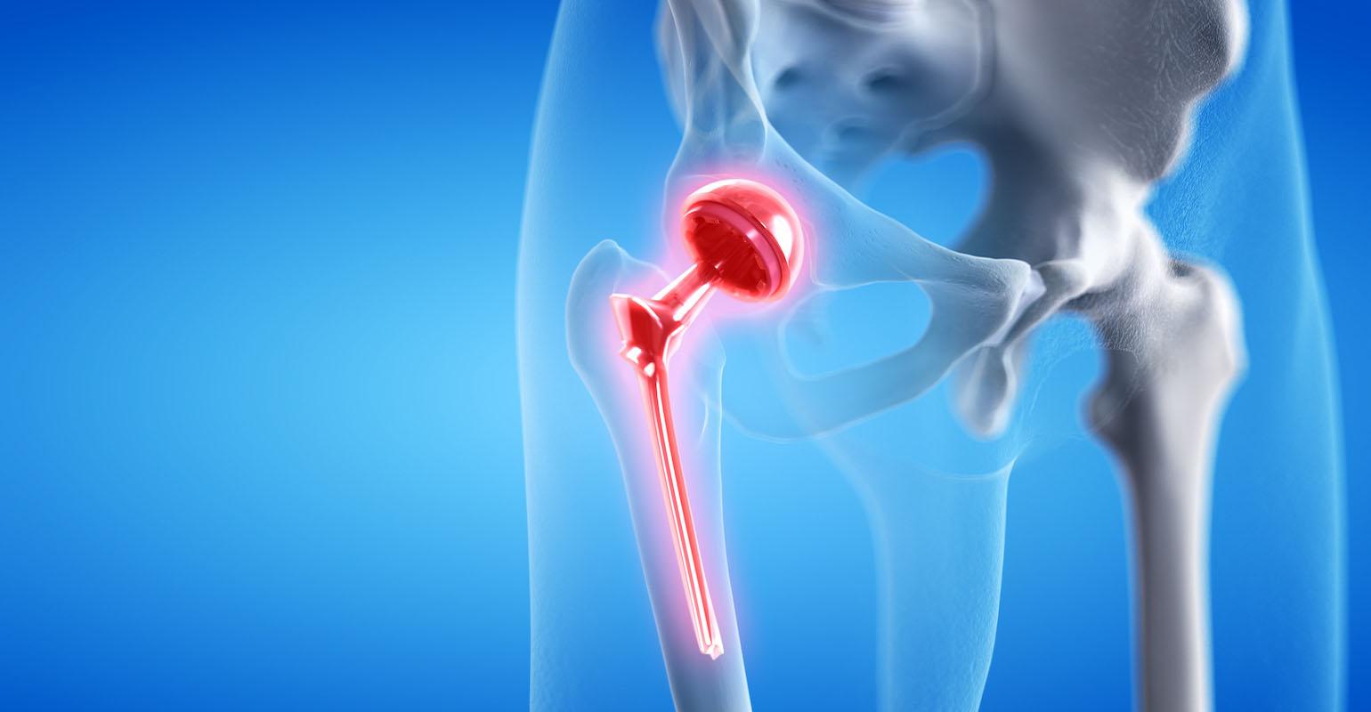 AI Can Now Make Implants That Last Longer Inside The Human B